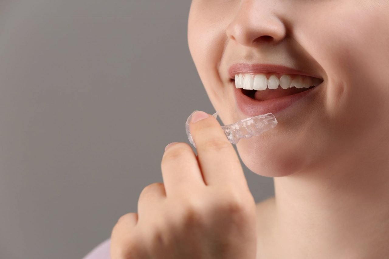 Get Relief from Bruxism & TMD with Occlusal Splints | Pacific Highway ...